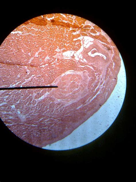 Moderator Band Histology