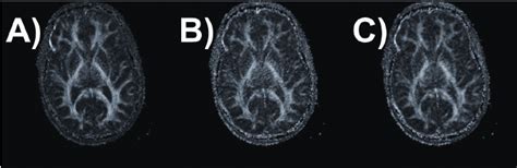 Fractional Anisotropy Maps Calculated Using A All Blades 1 Diffusion