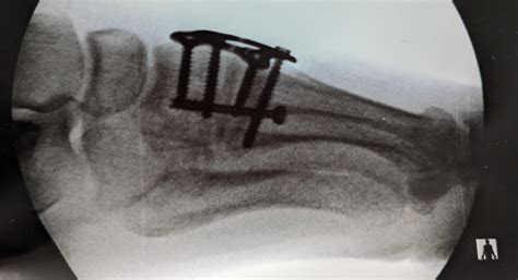 One Week Post Op Rlisfrancclub