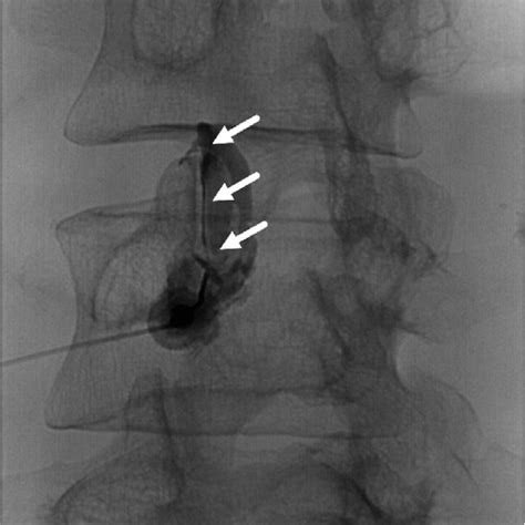A 35 Year Old Woman Undergoing An Intra Articular Facet Joint Steroid Download Scientific