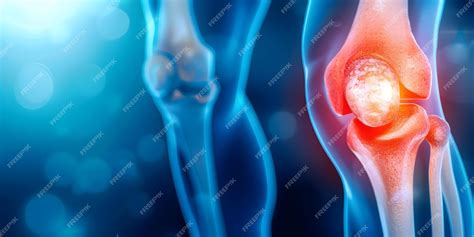 Conditions Affecting The Knee Joint And Bones Including Injuries And Diseases Concept Knee