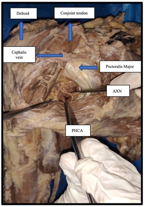 The Anterior Approach Showing The Quadrangular Space Between The