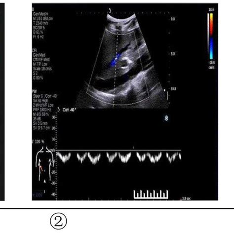 Type Of Doppler Waveforms Of The Hepatic Veins ① Triphasic Waveform ② Download Scientific