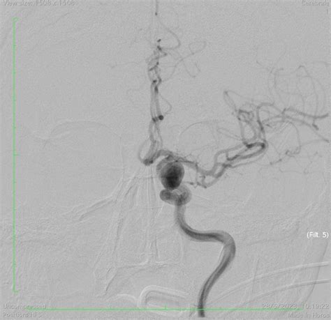 Redha Zeroual On Linkedin First Cases Of Flow Diverter Pipeline A