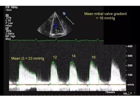 Echo Mitral Stenosis Pptx
