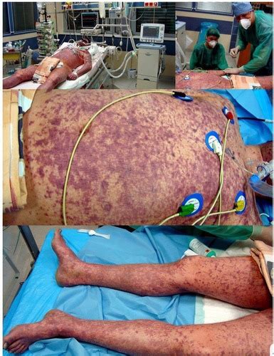 Disseminated Intravascular Coagulation Dic Flashcards Quizlet