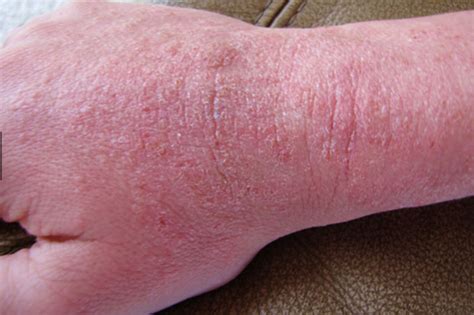 Сухой дерматит 8 фото причины симптомы лечение профилактика Лостерин