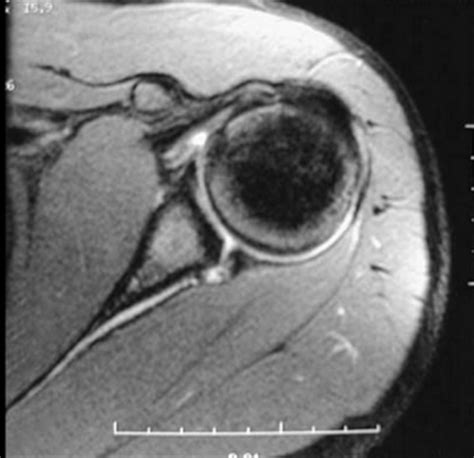 Posterior Labral Tear Shoulder And Elbow Orthobullets