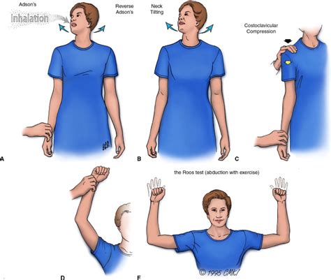 A Hand Surgeons Further Experience With Thoracic Outlet Compression