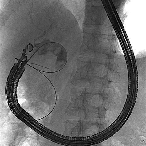 Duodenal Diverticulum With Nonvisualized Intradiverticular Papilla With Download Scientific