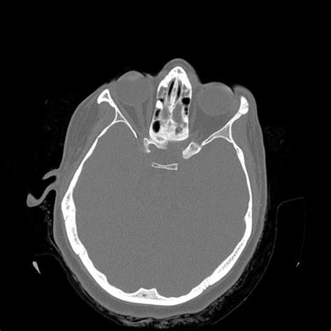 Chronic Sinusitis With Intra Sinus Calcification Radiopaedia 63919