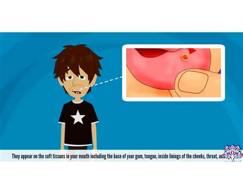 What Is Canker Sores All You Need To Know Odontovida