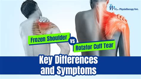 100 Articles Regarding Rotator Cuff Tear Physical Therapy