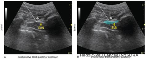 Nerve Block Ultrasound Guided Saphenous Nerve Block