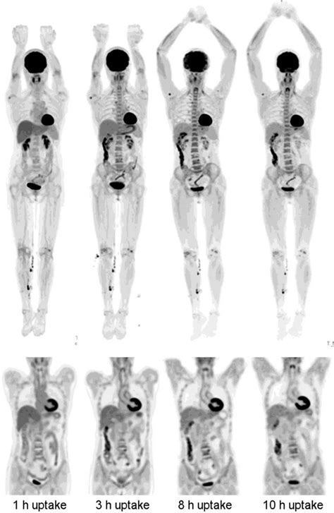 Delayed Imaging For Subject 2 256 Mbq Injected 14 Min Scan Duration Download Scientific