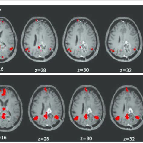 Seed Based Connectivity Maps For Pat Mpfc Overlaid On T1ce Weighted Download Scientific Diagram