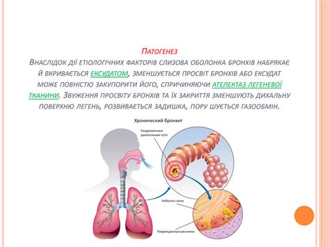 Презентація на тему Бронхіт