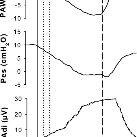 During An Airway Occlusion Patients Inspiratory Effort Is Equally Download Scientific Diagram