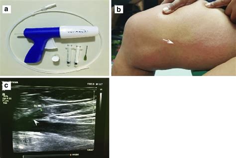 4 Cyanoacrylate Injection In Great Saphenous Vein Gsv Reflux A