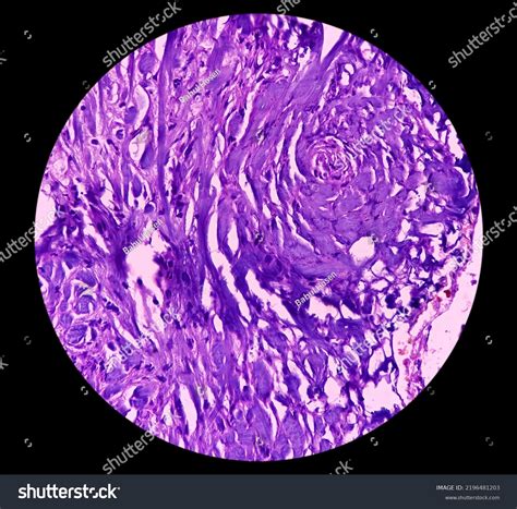 Suppurative Cholecystitis Gallbladder Show Perimuscular Fibrosis Stock