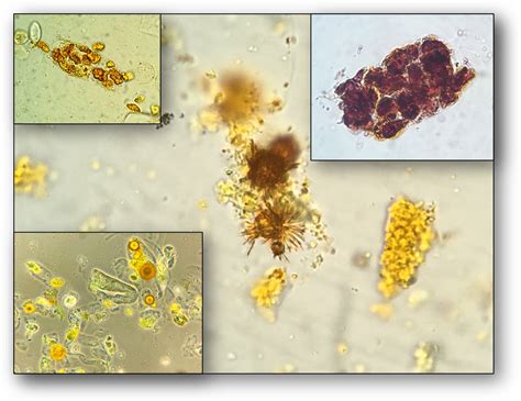 Bilirubin In Urine Under Microscope Urine Bilirubin Test Purpose Overview And More Lab Tests