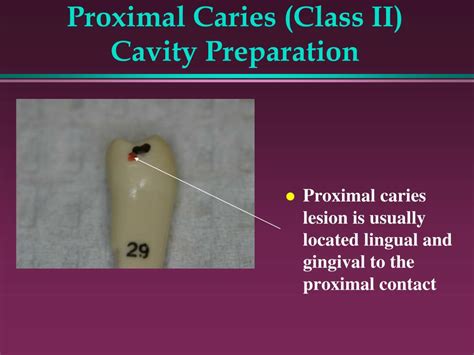 Ppt Class I And Ii Composite Restorations Principles And Techniques Powerpoint Presentation Id