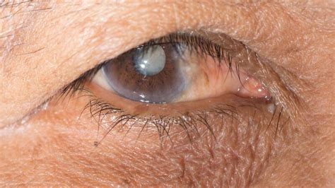 What Is A Nuclear Cataract Symptoms Causes And Treatment