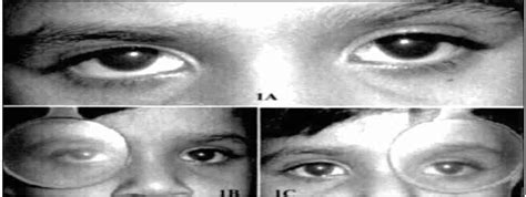 Bilateral Dissociated Vertical Deviation In A Case Of Congen