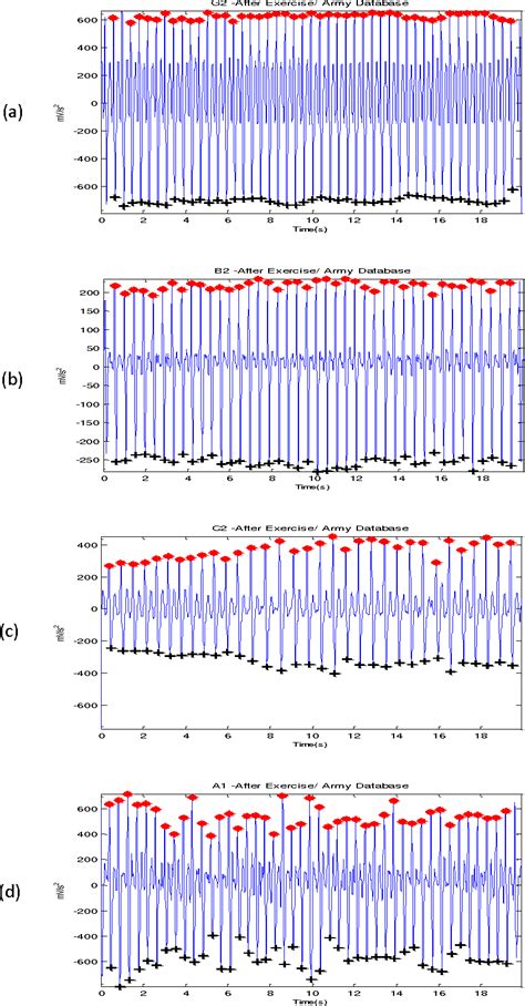 Figure 1 From A And B Waves Detection In Acceleration Photoplethysmogram Semantic Scholar