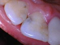 Cavity On Front Tooth Guide 1311 Jackson Ave Dental Dentist In