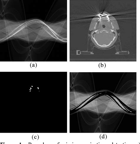 Figure 1 From A Novel Approach For Reducing Metal Artifacts Due To Metallic Dental Implants