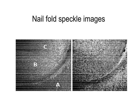 Ppt Monitoring Of Microcirculation By Full Field Speckle Correlation
