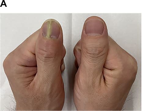 Ultrasound And Magnetic Resonance Image Findings In A Patient With A