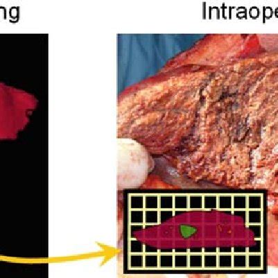 Basic Concept Design Of The Resection Map To Transfer The Preoperative Download Scientific