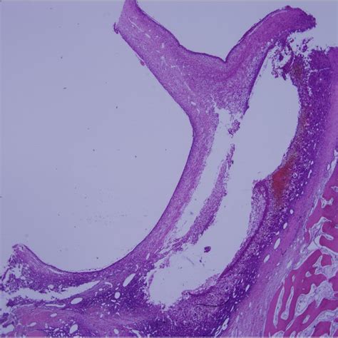 Pathology Shows Giant Cell Tumor Of Bone With Aneurysmal Bone Cyst The