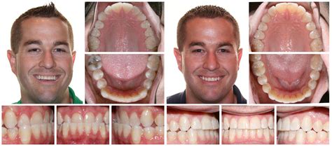 Invisalign Pics Before And After Transform Your Smile With Invisalign
