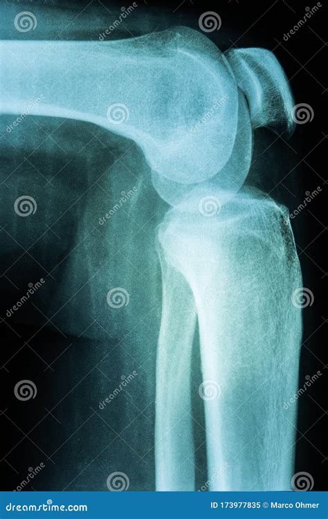 Ct Scan Knee Fracture Of Intercondylar Eminence Of Tibia Compression Fracture Of Posterior Of