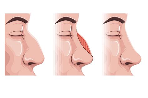 What Is Nose Type Chart What Does It Mean