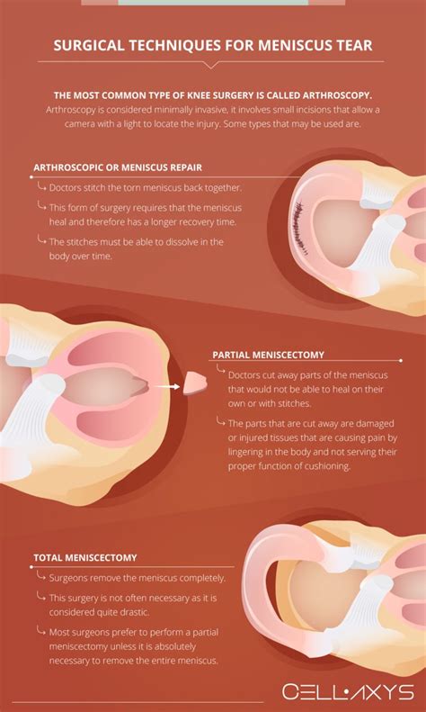 Treatment Strategies For Meniscus Tears And Their Alternatives Cellaxys