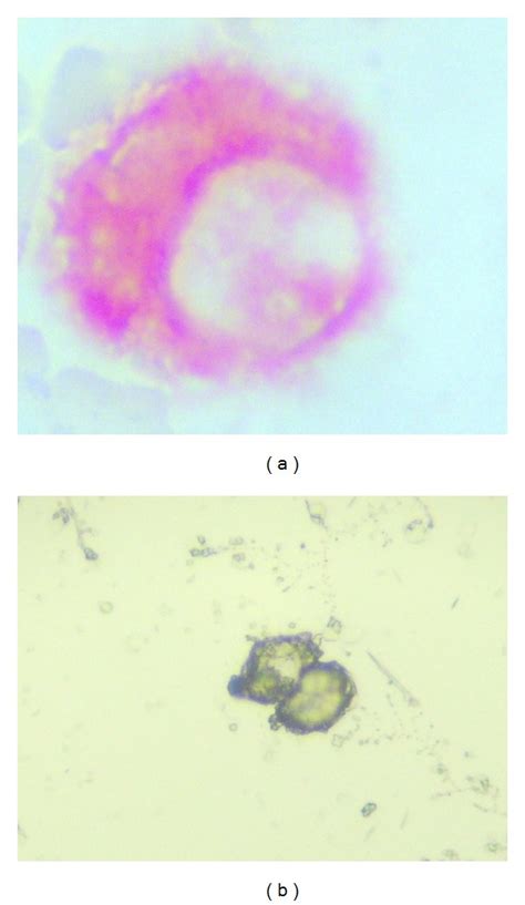 Differential Expression Of Matrix Metalloproteinase 2 Expression In