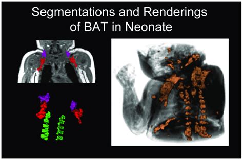 Neonatal Segmentations Bat Brown Adipose Tissue Segmentations In The