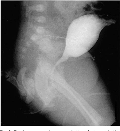 Figure 1 From A Case Of Patent Urachus Semantic Scholar
