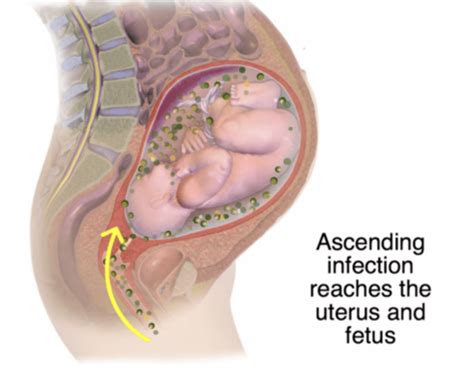 Chorioamnionitis Flashcards Quizlet