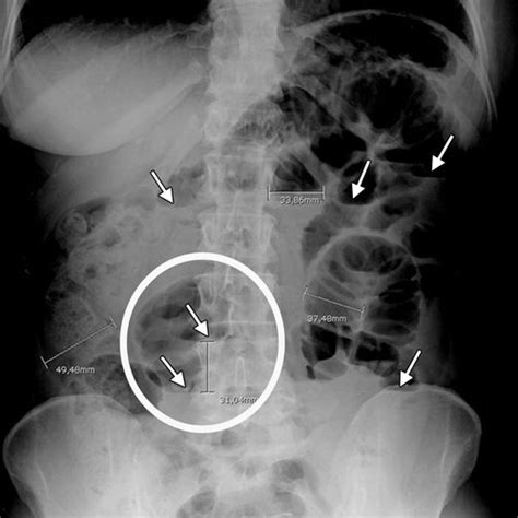 Small Bowel Obstruction What To Look For Radiographics