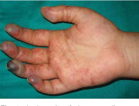 Figure 1 From Cutaneous Manifestations Due To Septic Shock In An Adult
