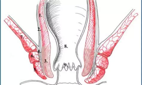 Intersphincteric Resection Of The Rectum Temporary Solution For Patients Rejecting Permanent