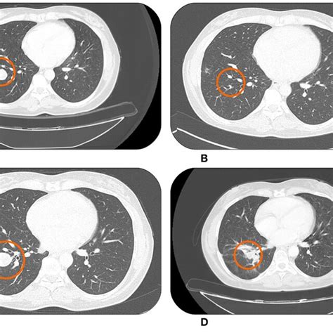 Lung Metastases From Uterine Leiomyosarcoma Right Before Starting Download Scientific Diagram