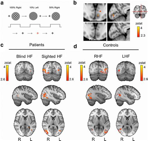 Fmri Procedure And Activation Results For High Contrast Motion A Download Scientific Diagram