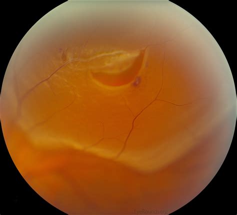 Vitreous Syneresis An Impending Posterior Vitreous Detachment Pvd