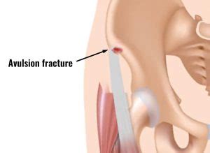 Rectus Femoris Tendon Strain Symptoms Causes Treatment Rehab